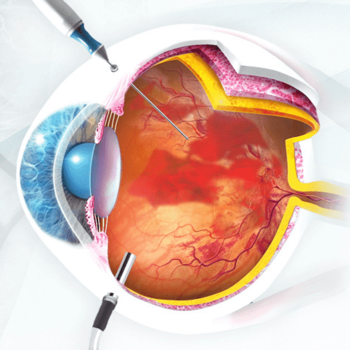 Retinal Vein Occlusion (RVO) - Strategic Pharmaceutical CI Insights